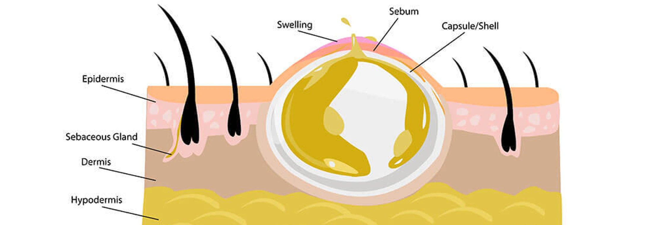 3 Best Home Remedies To Get Rid Of Sebaceous Cysts - Follow The Women